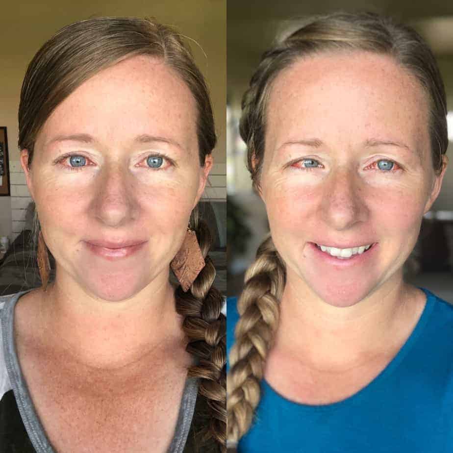 10 Simple Steps to Prepare for Successful Strabismus Surgery ...