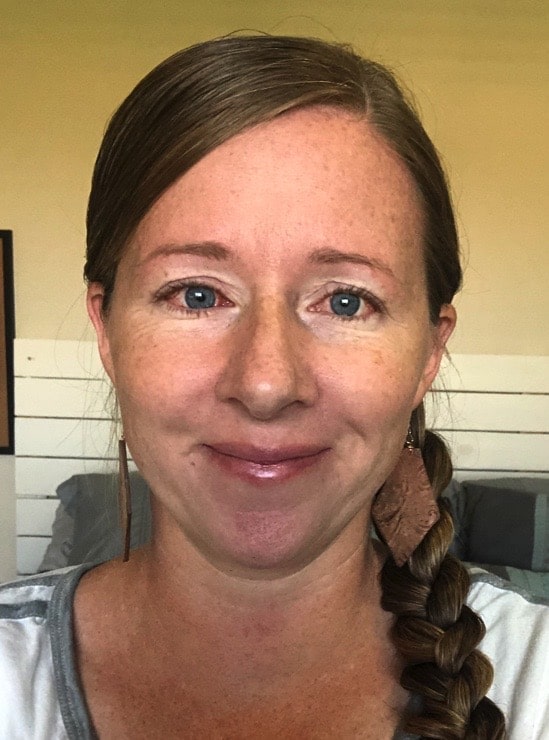 What is Recovery from Strabismus Surgery Like? Daily Details ...